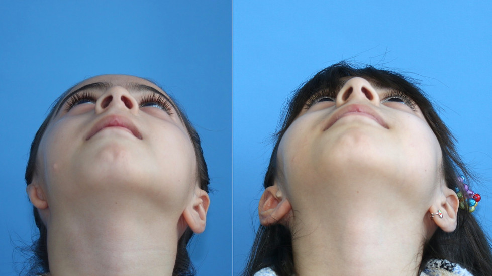 Microtia Treatment | Microtia Clinic | Muğla