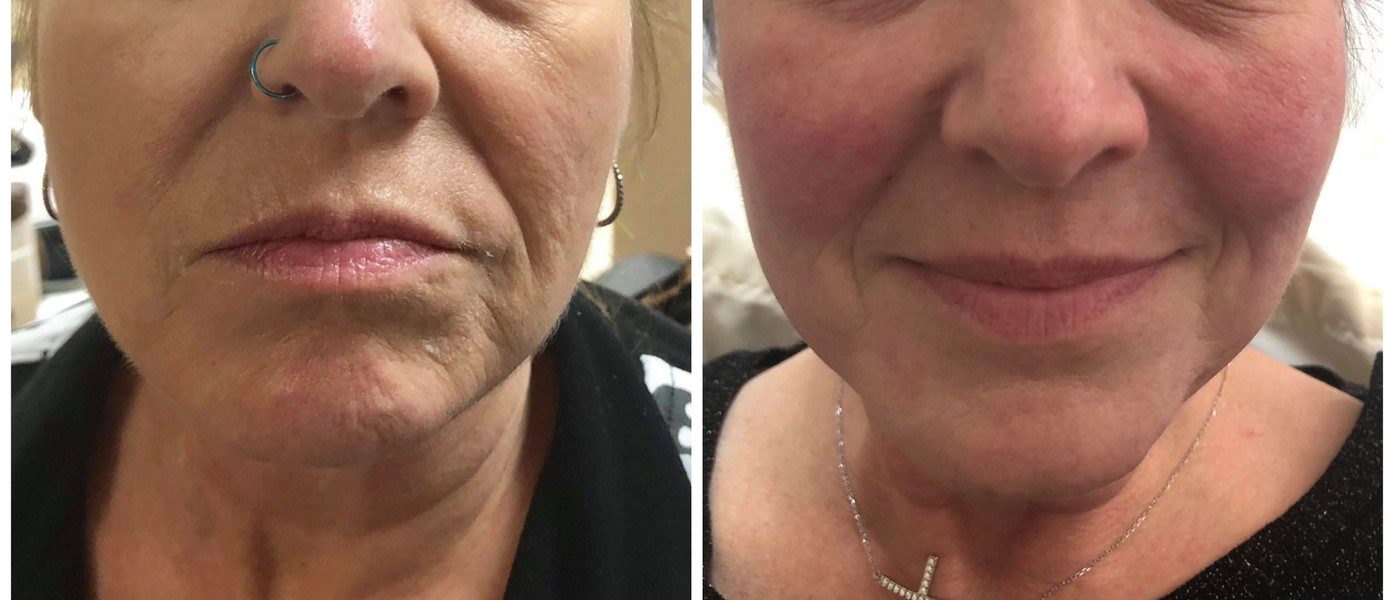 Before & After PDO smooth threads