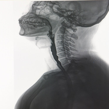 FEES vs MBSS | Scope SLP