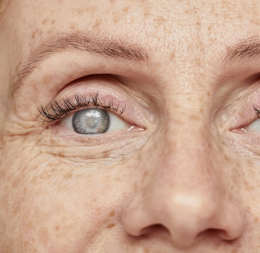 Cataract | The Straits Eye Community Clinic