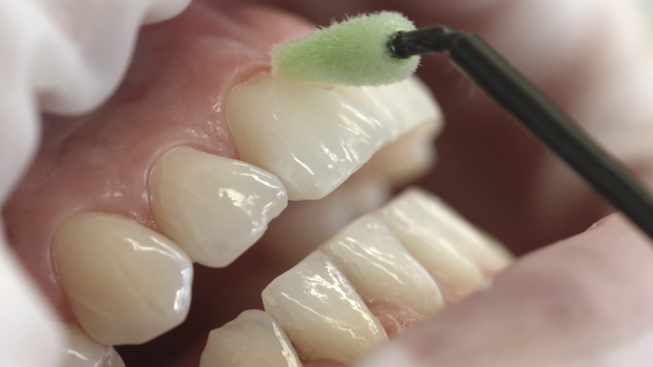 DENTAIRE SAINT JUST | Soins PROPHYLAXIE DENTAIRE Marseille