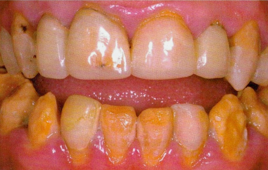 Les colorations de vos dents