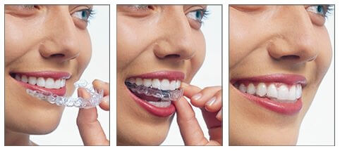 INVISALIGN : GUIDE ULTIME POUR LES PATIENTS