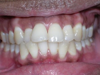 Gum Disease and Bone Loss