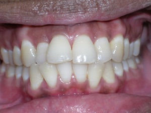 Gum Disease and Bone Loss