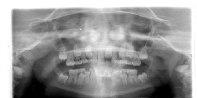 Impacted Upper Front Tooth