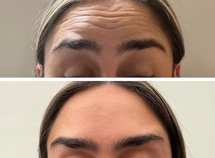 Long Island Botox | Xeomin | Dysport | Daxxify - Sayville & RVC