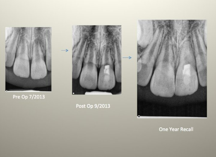 Regenerative Endodontics