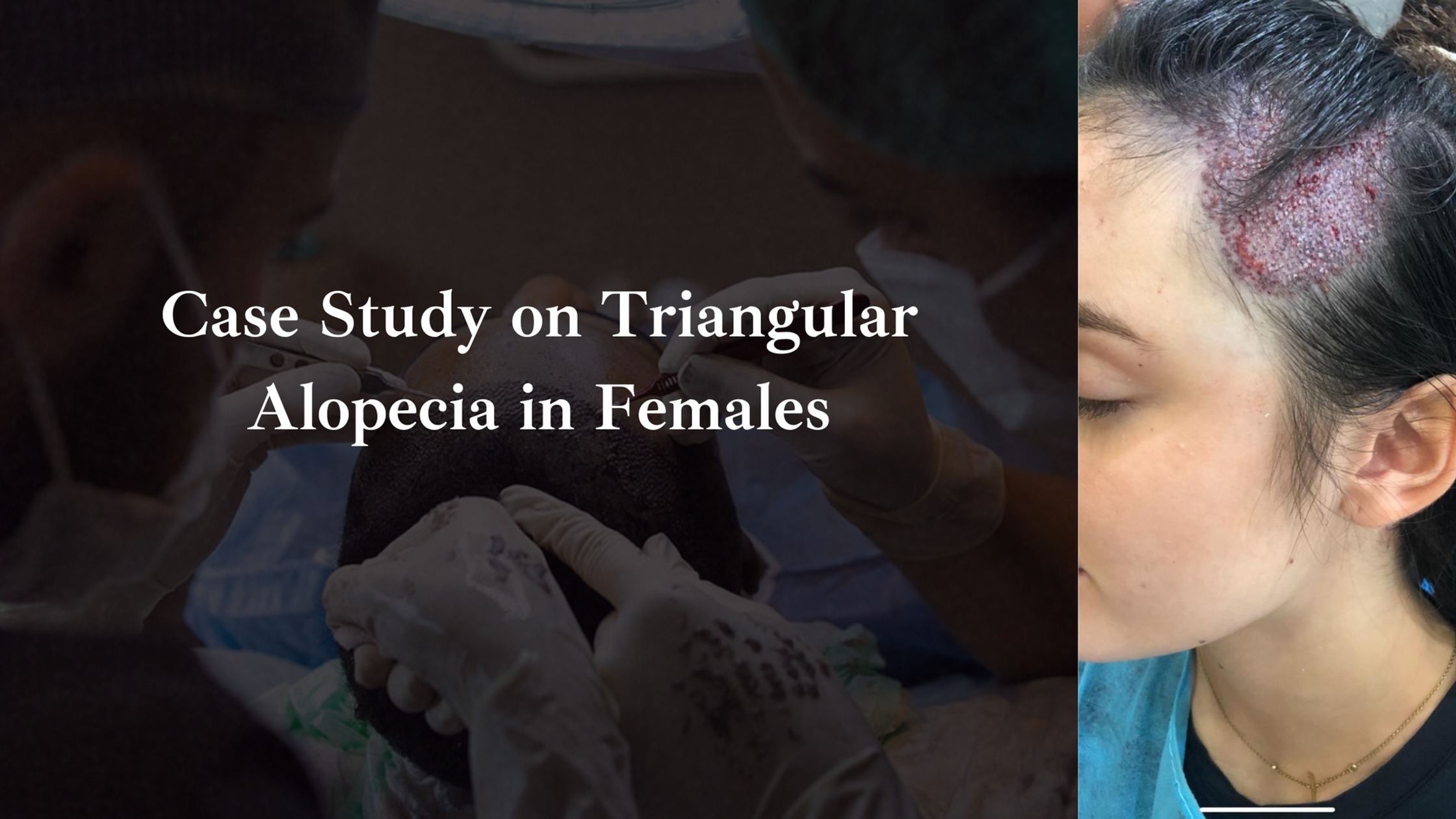 Case Study on Triangular Alopecia in Females: A Journey to Recovery ...