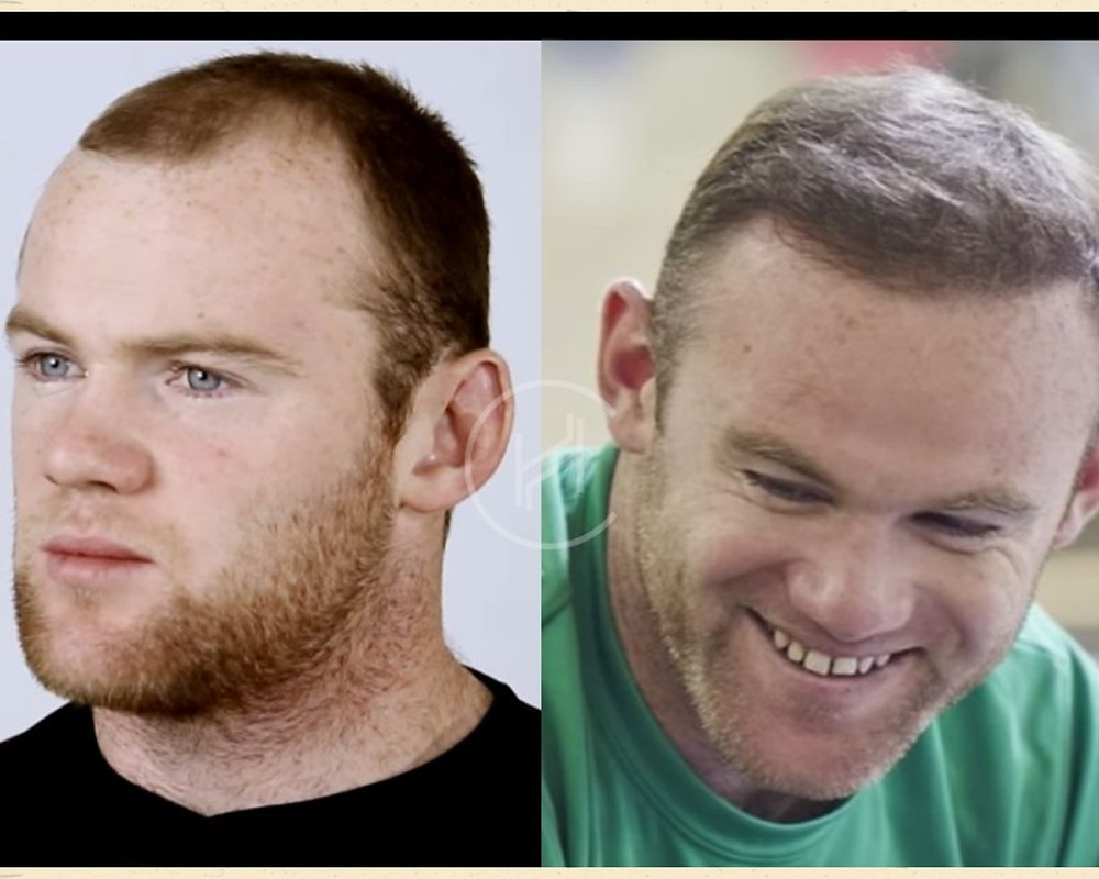 Celebrities with Hair Transplants: Before and After Transformations