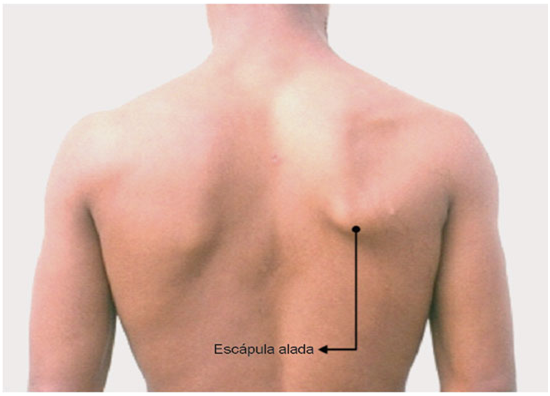 FISIOnews | Escápula alada: entenda o problema