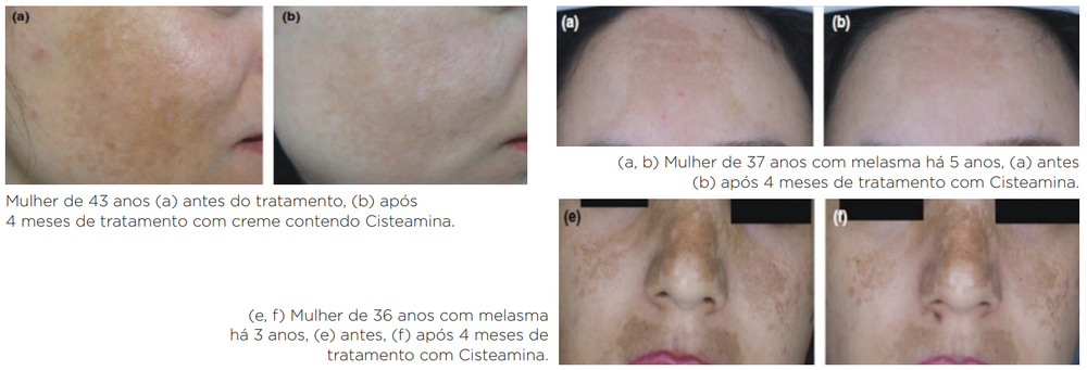 Cisteamina | A EVOLUÇÃO NO TRATAMENTO DO MELASMA RESISTENTE