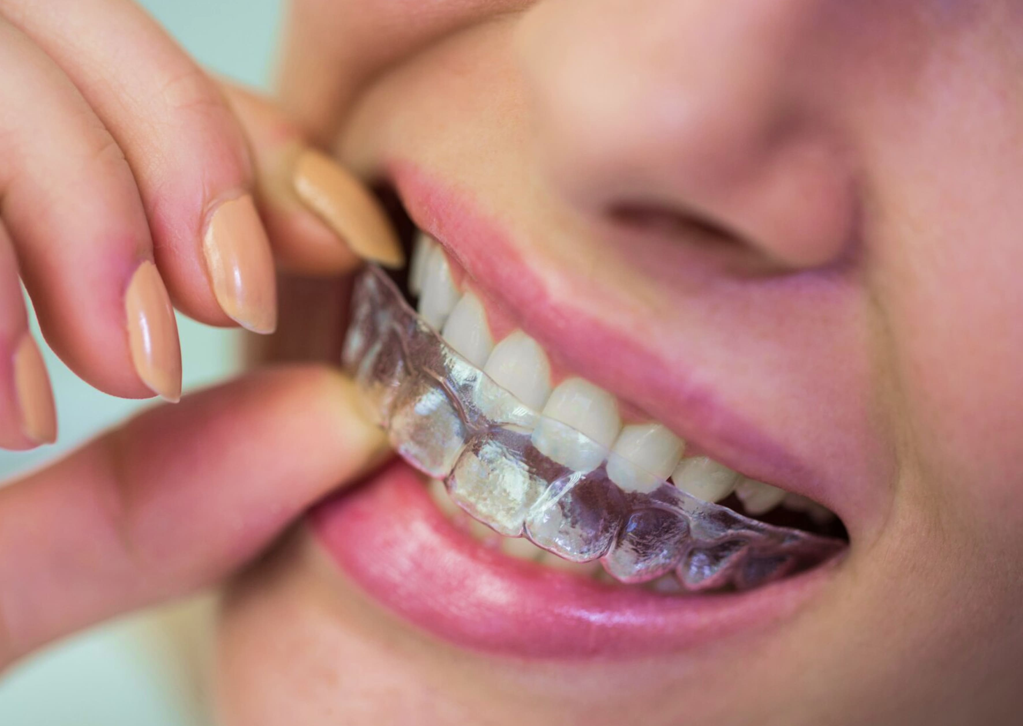 Retainers in Houston, TX - Inspire Dentistry