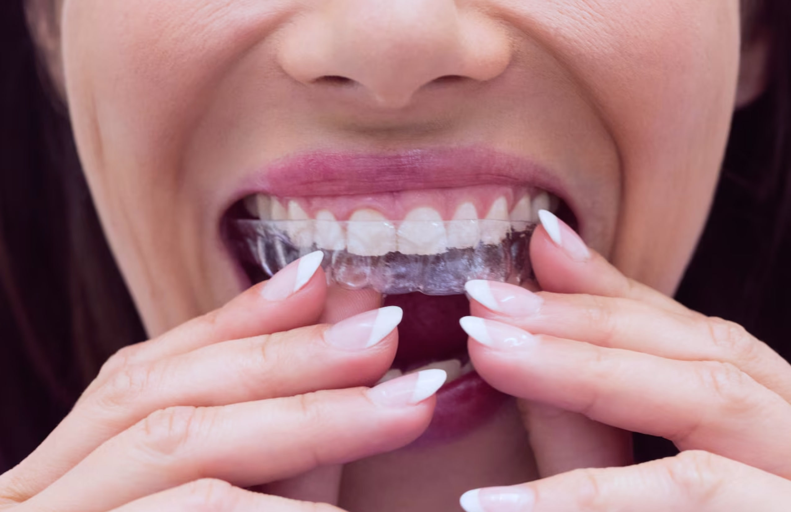 Invisalign Clear Aligners in Chicago, IL - Lakeview Smiles