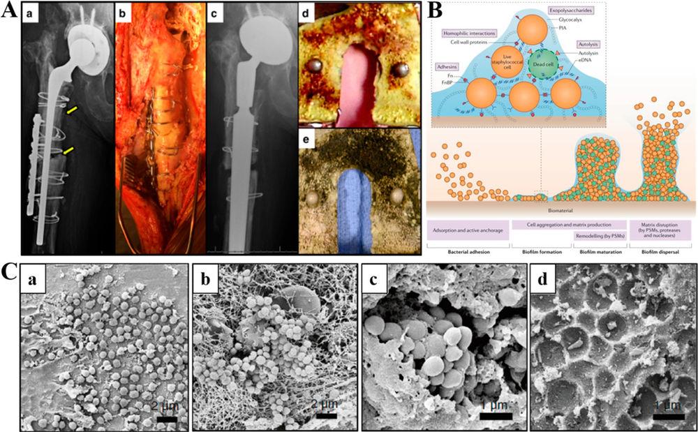 Toward Designing of Anti-infective Hydrogels for Orthopedic Implants ...
