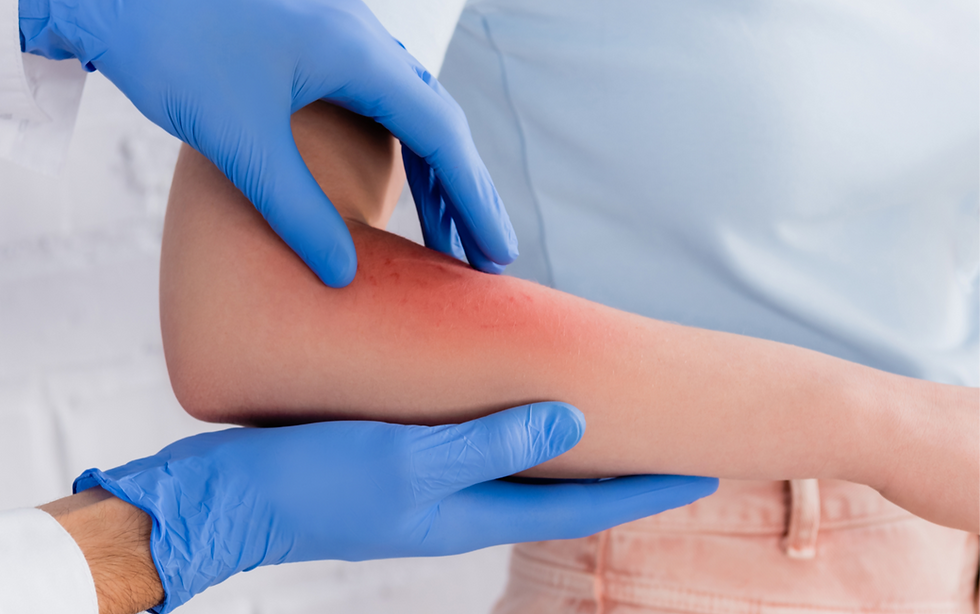 Managing Chronic Urticaria: Treatment Strategies