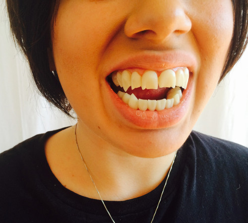 Custom Fangs and Vampire Teeth Orders and Sales