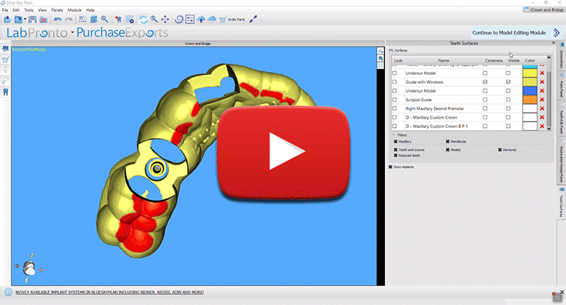 Boolean Videos: Create Custom Healing Abutments, Nightguards, Implant ...