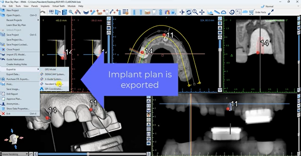New Live Navigation Capabilities Launched with BSP to Navident Bridge