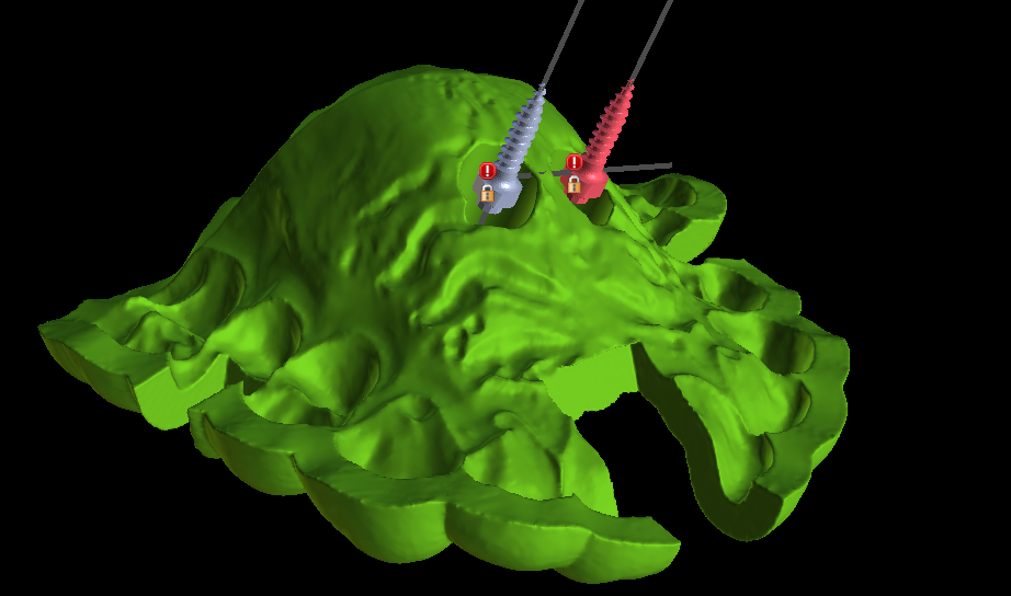 Simplify TAD Planning With Maxilla Auto Segmentation and BlueSkyPlan Guide!