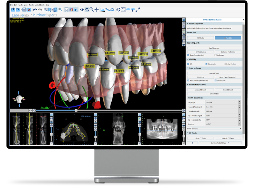 CT Root Based Aligner Planning Now Available! Predictable, Faster ...