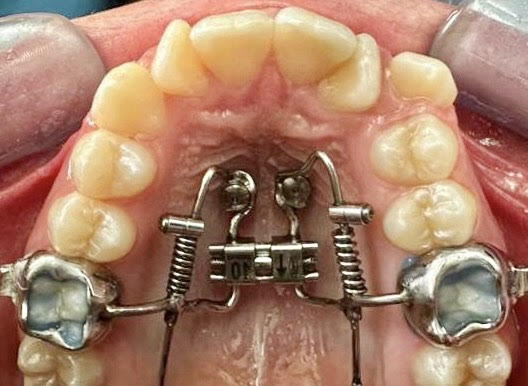 Simplify TAD Planning With Maxilla Auto Segmentation and BlueSkyPlan Guide!