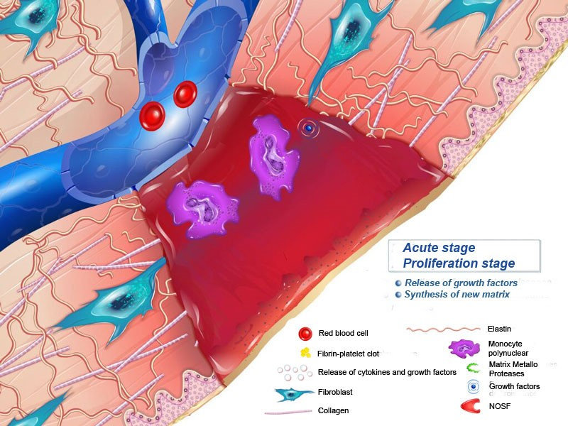 Proliferation: the next phase of healing