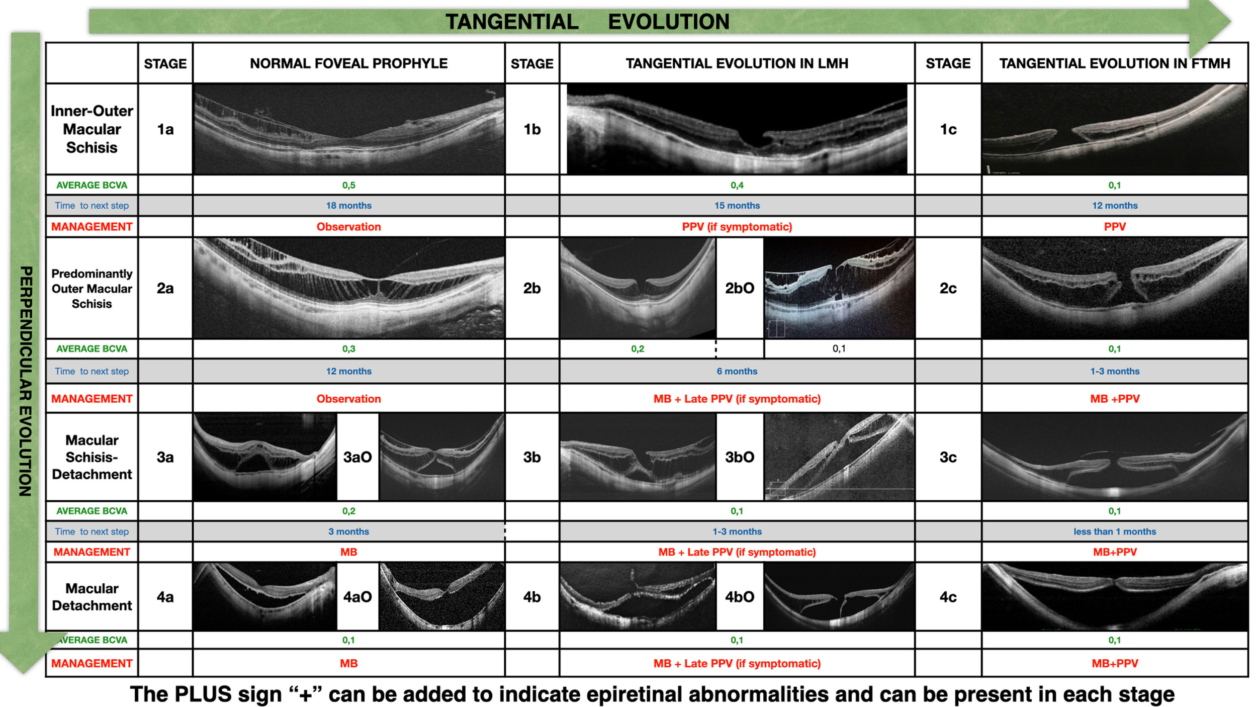Barbara | Parolini | Trattamento miopia elevata