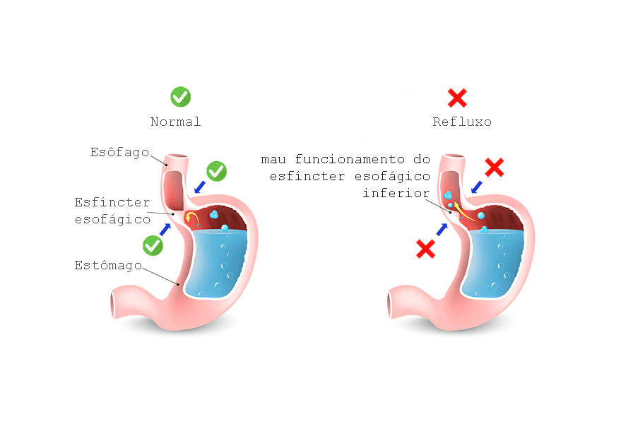 Entendendo o Refluxo Gastroesofágico