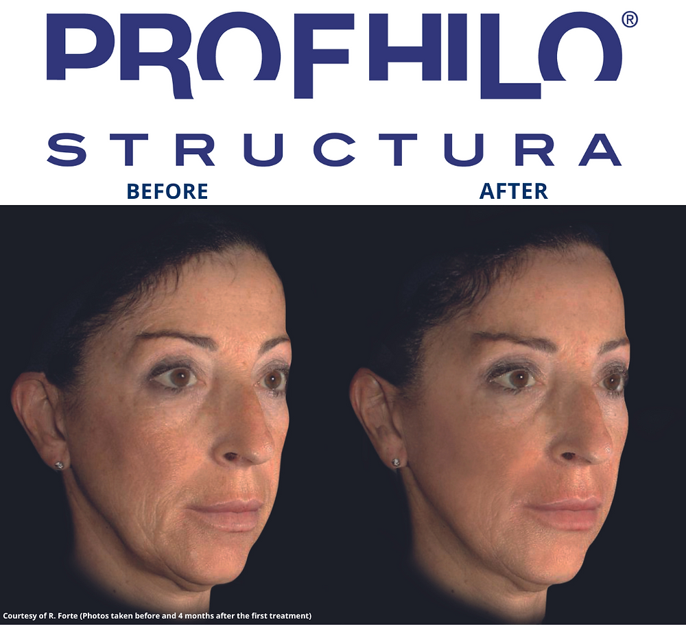 Profhilo Structura