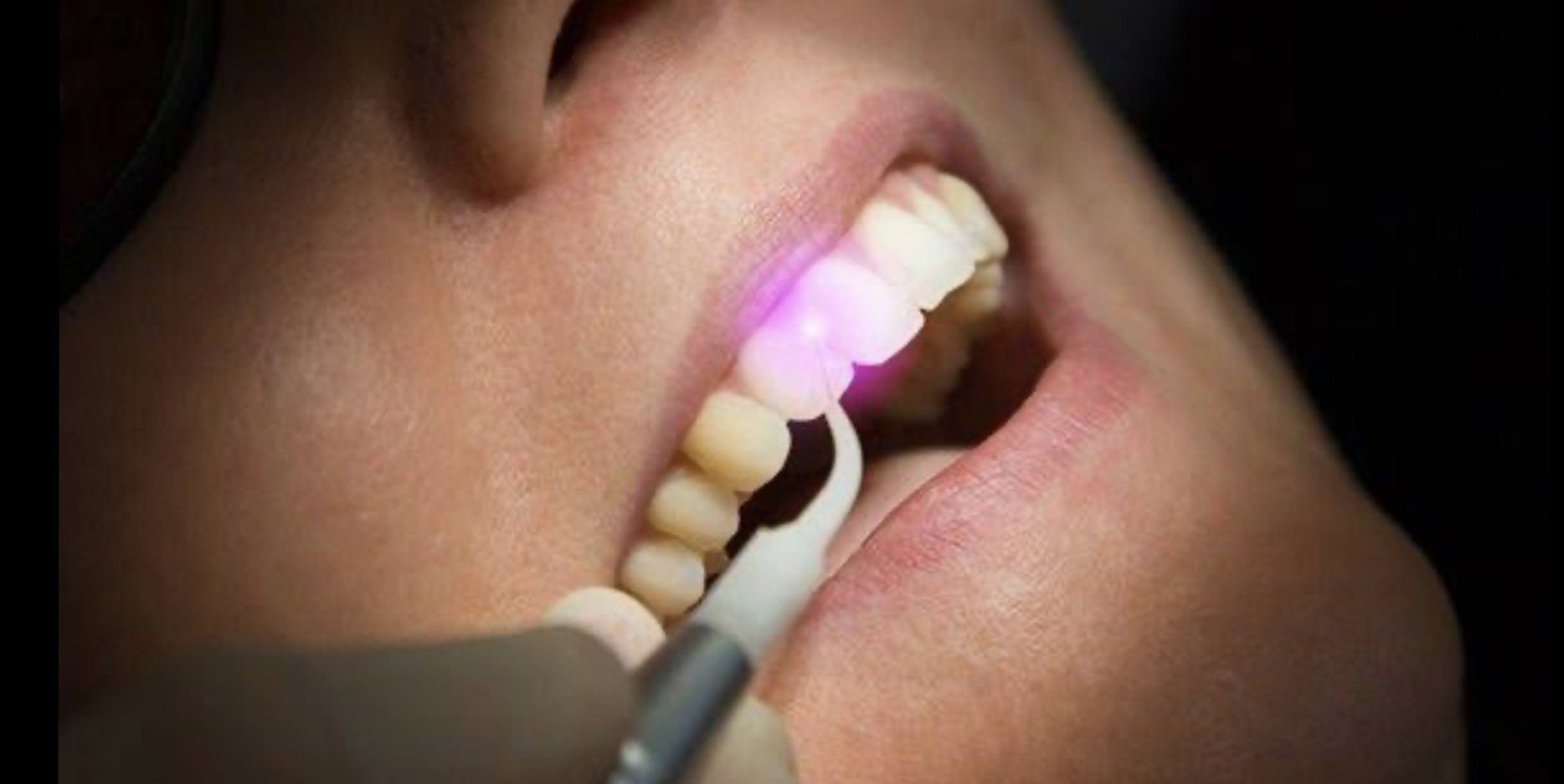 Periodoncia en Lima Perú | Clínica Dental Unlimited