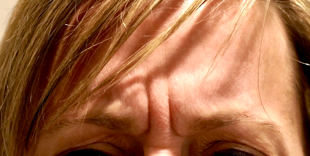 How To Address Deep Glabellar Lines (The Dreaded "11's")