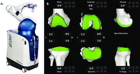 Knee Replacement | Robot Assisted | Mako | Sutherland Shire