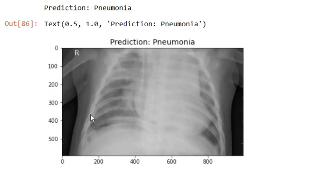 Pneumonia Detection Model Using Deep Learning Deep Learning Projects Codersarts Ai