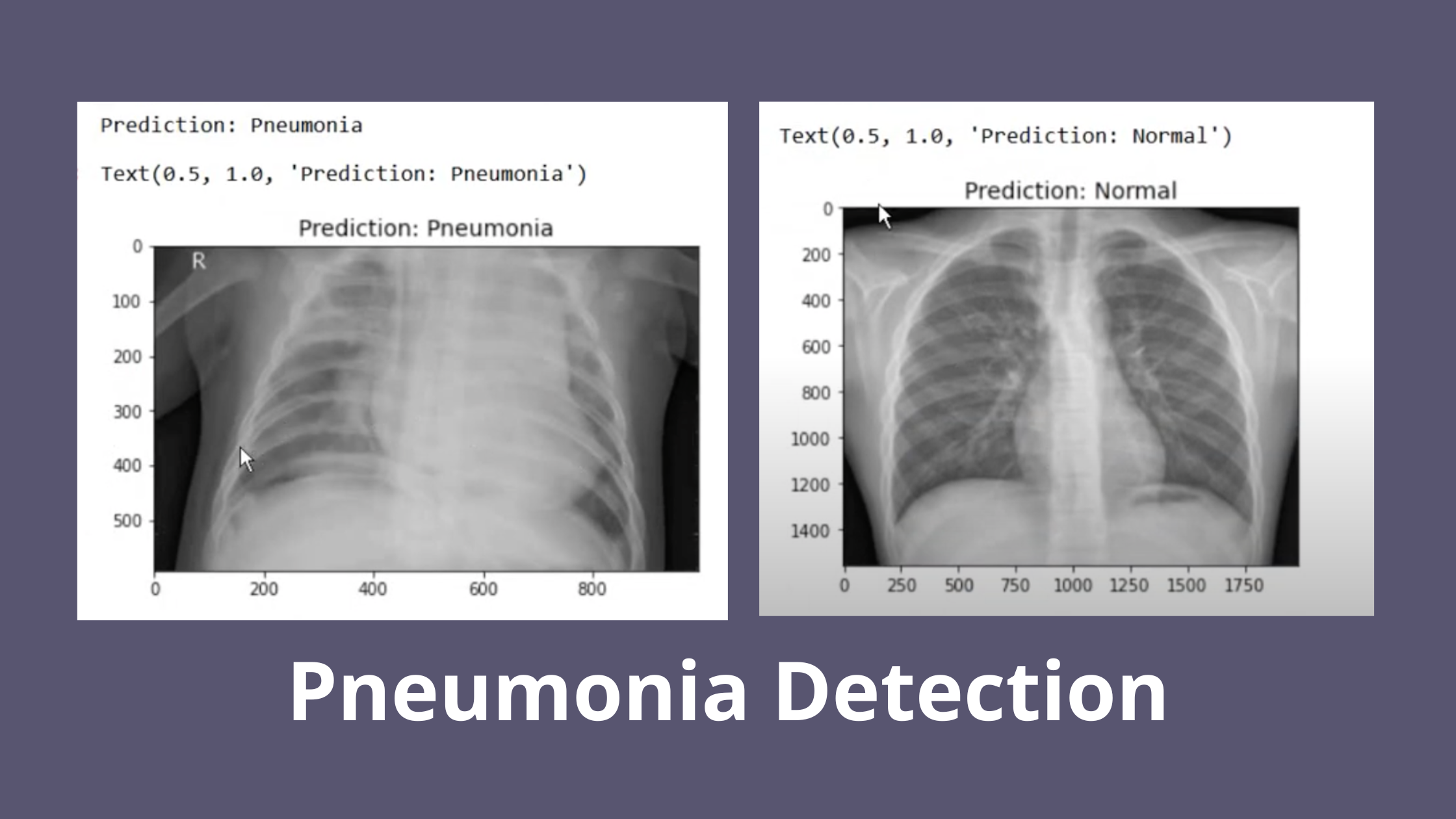 Pneumonia Detection Model using Deep Learning | Deep Learning Projects ...