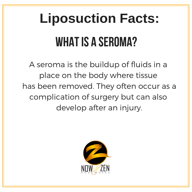 What is a Seroma?