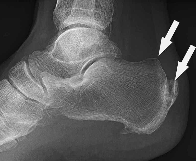 Is your heel pain caused by Haglund’s Deformity? | TMA