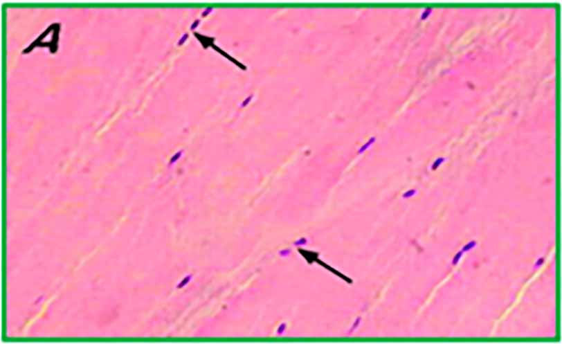 Why do I have a lump in my Achilles tendon?