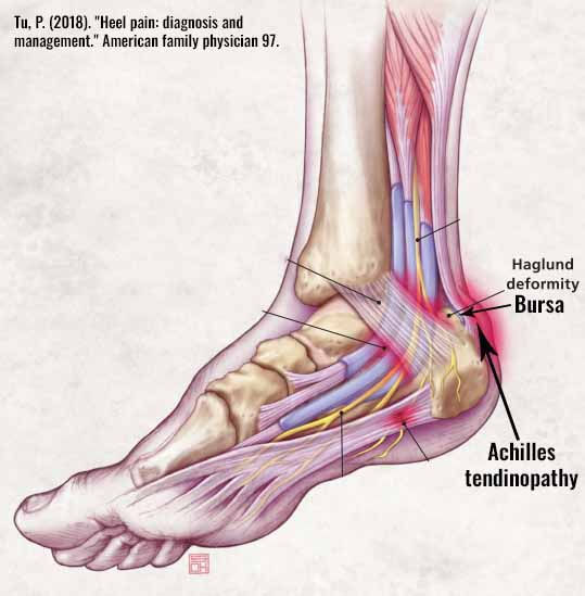 Heel bursitis: Causes and treatment | Treat My Achilles