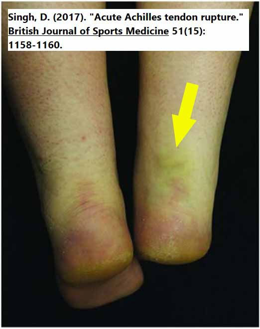 Achilles Tendon Ruptures/Tears - Diagnosis & Treatment | Treat My Achilles