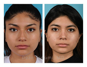 Primary Rhinoplasty | Chicago, IL | Dr. Dean Toriumi, MD