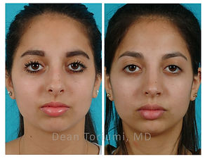 Primary Rhinoplasty | Chicago, IL | Dr. Dean Toriumi, MD