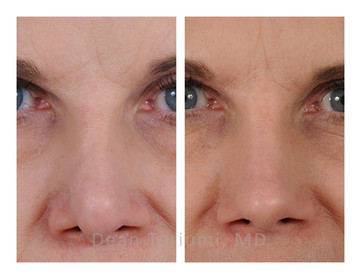 Revision Rhinoplasty | Chicago, IL | Dr. Dean Toriumi, MD