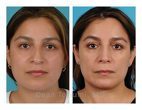 Revision Rhinoplasty | Chicago, IL | Dr. Dean Toriumi, MD