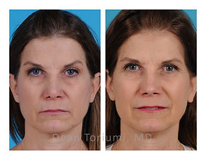 Revision Rhinoplasty | Chicago, IL | Dr. Dean Toriumi, MD