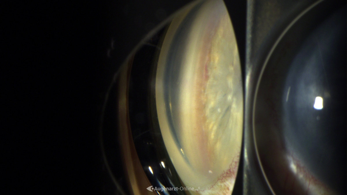 Rubeosis iridis bei Shaffer III | Atlas der Augenheilkunde