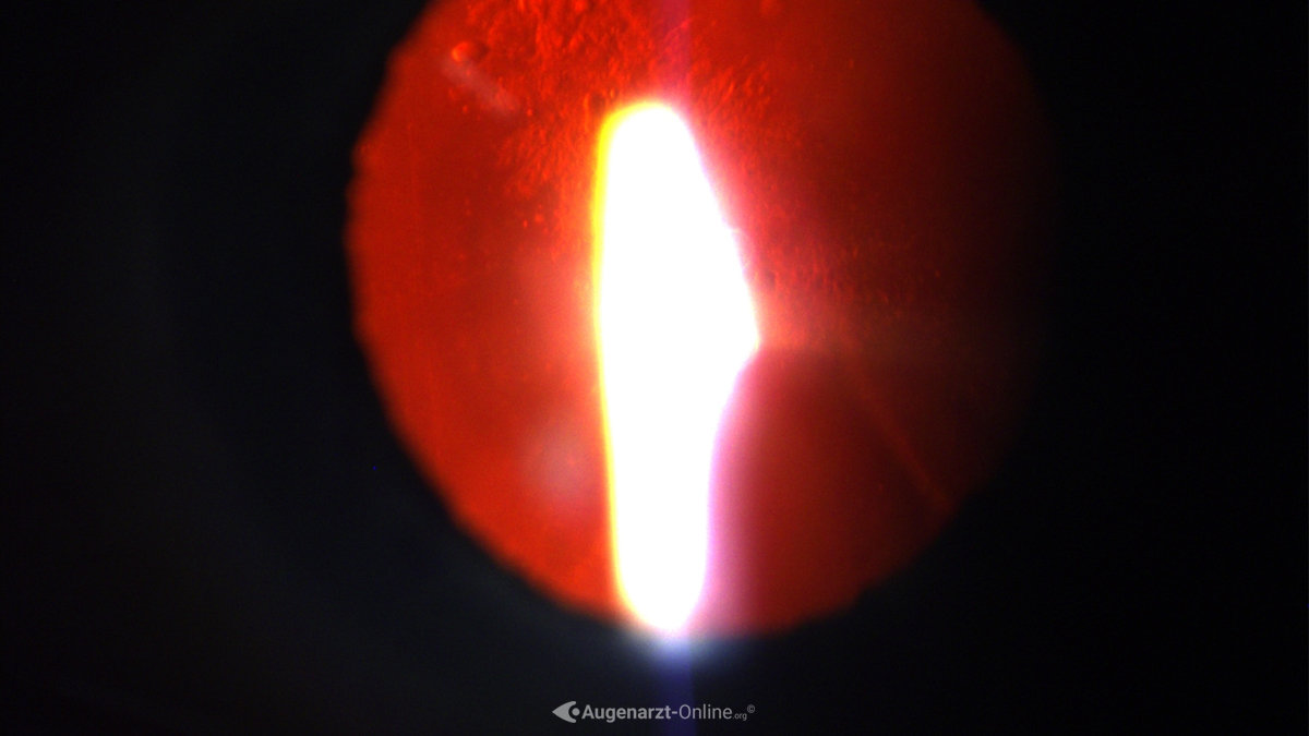 Katarakt | Atlas der Augenheilkunde