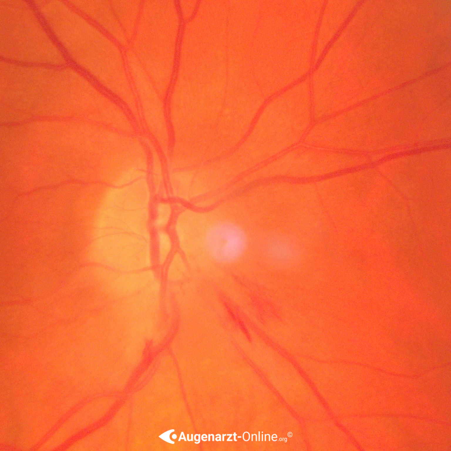 Nicht Arteritische Ischämische Optikus Neuropathie (NAION) | Atlas der ...