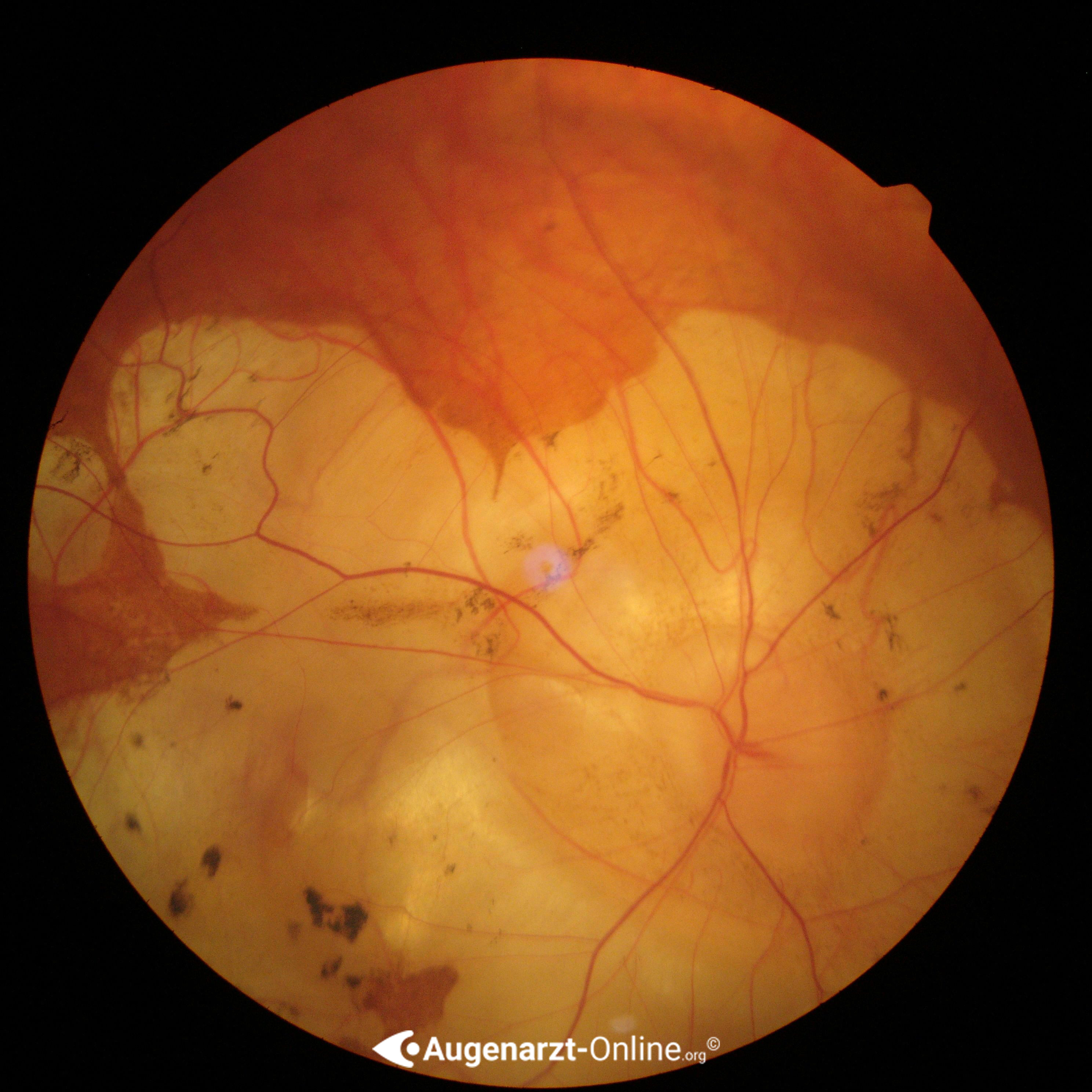 Myopia Magna | Atlas der Augenheilkunde