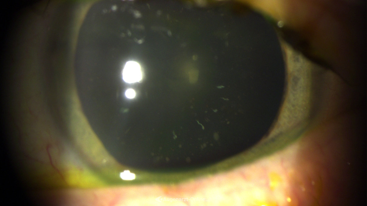Cerulean Cataract